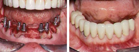 Jaw Bone Cancer | Treatments | Dr Rahul Buggaveeti