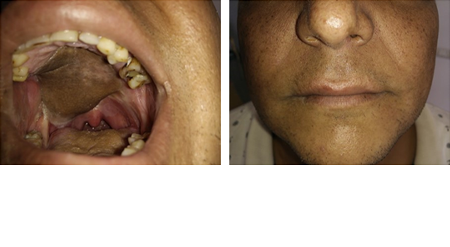 Sinus Cancer Surgery in Hyderabad | Dr. Rahul Buggaveeti